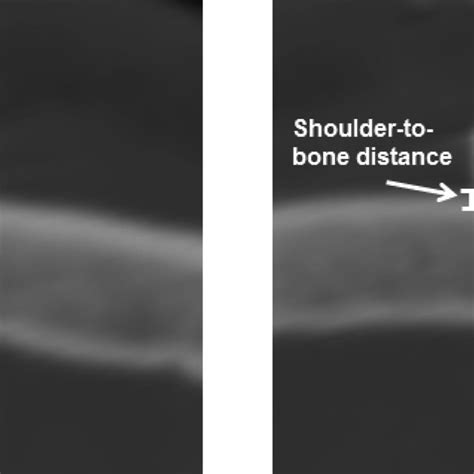 Pdf Clinical Testing Of An Alternate Method Of Inserting Bone Implanted Fiducial Markers