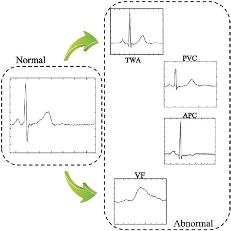 Ecg Signal Of Some Kind Of Heart Arrhythmia Download Scientific Diagram