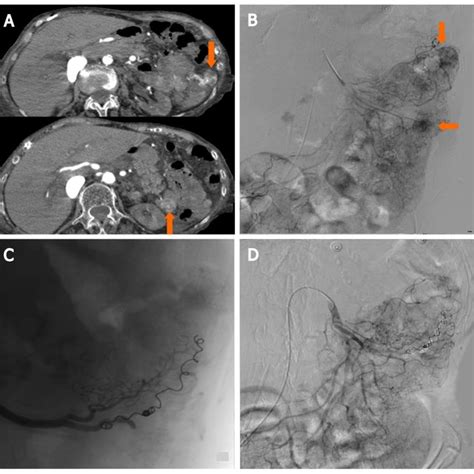 87 Year Old Female With Distal Duodenum Proximal Jejunum Ca Presents Download Scientific