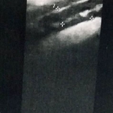 Intraoperative View Showing Appendicular Mass Download Scientific