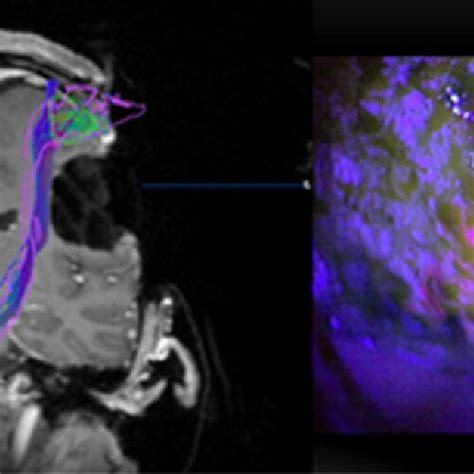 Left Gross Total Tumor Resection Gtr Was Achieved According To
