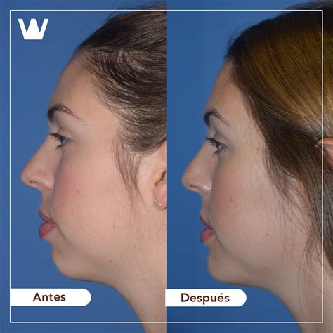 Implante De Menton Masculino Antes Y Despues