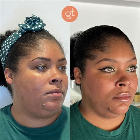 Before And After Gallery Dermal Fillers Stunning Transformations