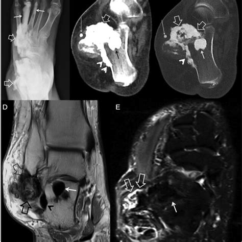 Value Of Ct In Melorheostosis A 60‐year‐old Female Patient Melo‐13 Download Scientific