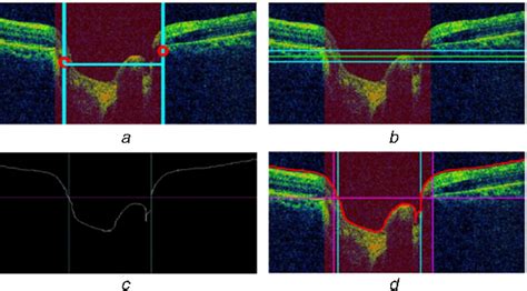 figure 12 from automated glaucoma detection using retinal layers