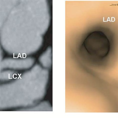 A 59 Year Old Man With A Left Circumflex Artery Lcx Anomalous Origin Download Scientific