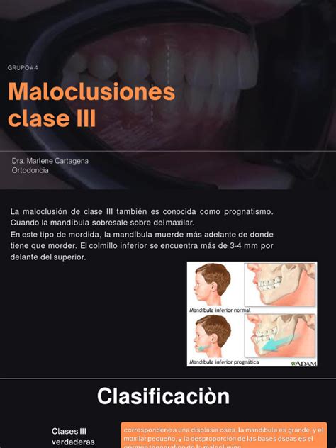 Maloclusion Clase Iii Pdf
