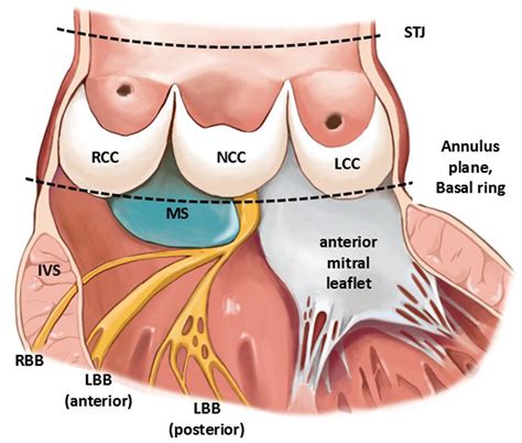 Computed Tomography To Predict Pacemaker Need After Transcatheter