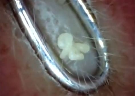 Pimple Microscope Pimple Microscope