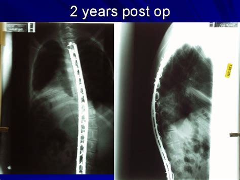 Growing Segmental Spinal Instrumentation Without Fusion In Spinal