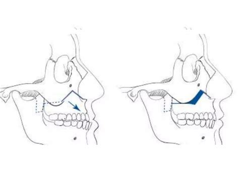Maxillary Orthognathic Surgery Pptx