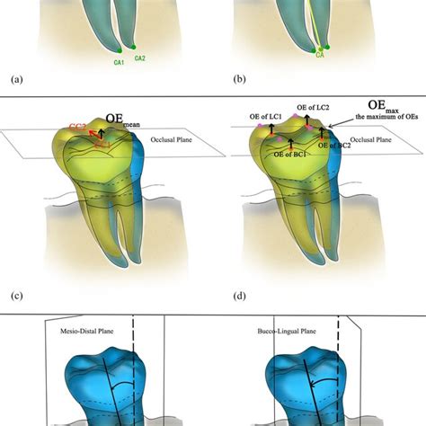 Distribution Of Overeruption And Tipping In Different Sites Of Molars