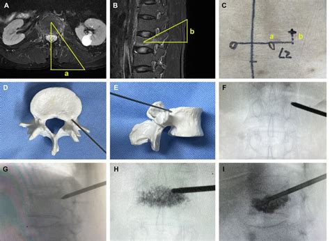 Interventional Radiology Kyphoplasty At Ellie Ezell Blog