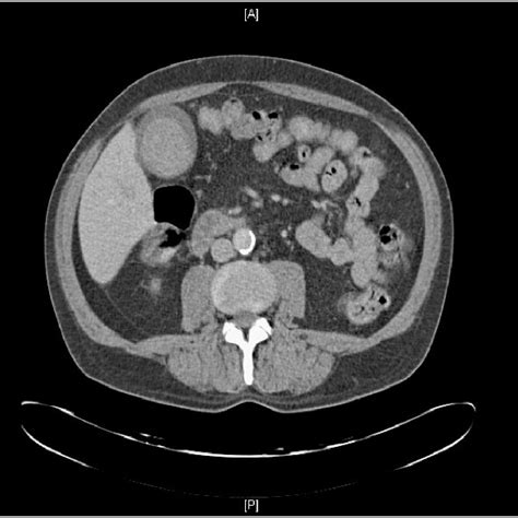 Ct Abdomen And Pelvis Showing Acute Gallbladder Haemorrhage Download
