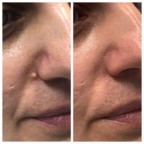 Mole Removal Before And After Before And After Mole Surgery