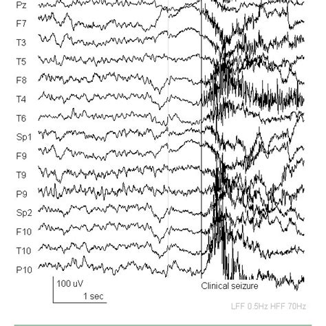 Eeg Shows A Subclinical Left Lateral Temporal Electrographic Seizure