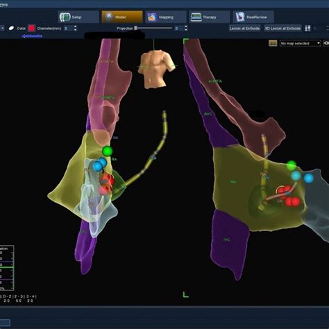 Final Simplified 3 Dimensional Electroanatomic Mapping For Ablation Of