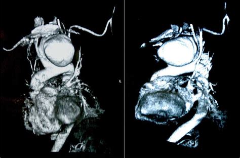 Mycotic Aneurysm Of The Aortic Arch Revista Española De Cardiología