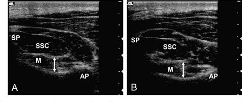 Figure 2 From Measurement Of Cervical Multifidus Contraction Pattern With Ultrasound Imaging