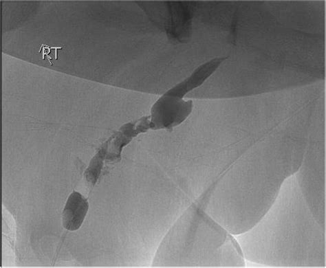 Surgical Management Of A Large Iatrogenic Urethral Diverticulum In A