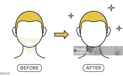 수염 제모 치료 전후의 이미지 그루터기에서 매끄러운 피부까지 그루터기 얼굴부위 털에 대한 스톡 벡터 아트 및 기타 이미지 그루터기 얼굴부위 털 만화 머리가 빠지다