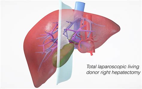 Laparoscopic Anatomical Resection Of Segment 4b And 8 Using The Caudal View Tvasurg The