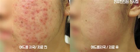 패인곳에 새살을 차오르게 하기 위해서는 흉터 밑바닥에 침을 통해서 하나 하나 끊어주는 작업이 필요합니다