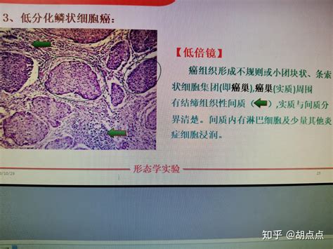 鳞状上皮乳头状瘤、高分化鳞状细胞癌、低分化鳞状细胞癌、直肠腺癌、平滑肌瘤、平滑肌肉瘤，病理组织切片 知乎