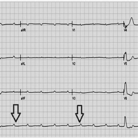 Transient Ventricular Asystole Cardiac Arrest Shortly After Initial