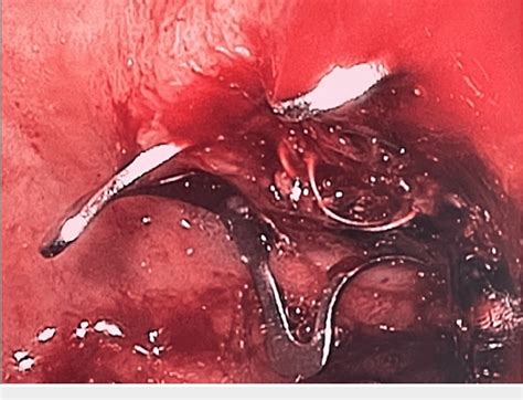 Figure 1 From Endoscopic Visualization Of The Embolization Coil With Subsequent Endoscopic