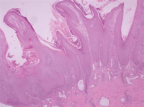 Figure 1 From Pyoderma Vegetans Associated With Severe Psoriatic