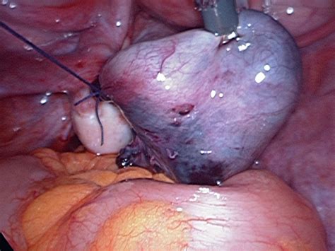 Salpingectomy