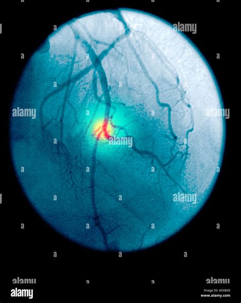 Colorized Xray Of The Left Anterior Descending Coronary Artery Lesion