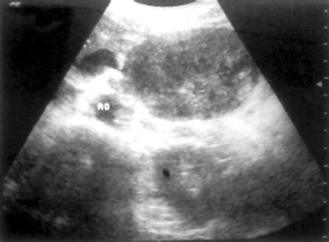 Figure 1 From Gastrointestinal Stromal Tumour Gist From An Imaging Perspective Semantic Scholar