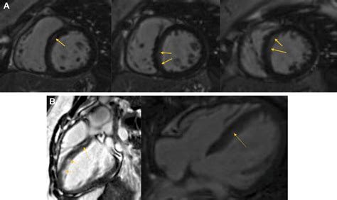 Cardiac Magnetic Resonance Download Scientific Diagram