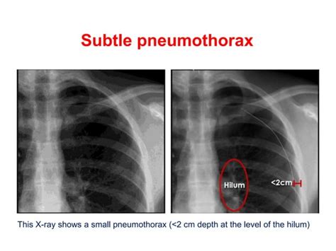 Pneumothorax In Chest Xray Interpretationpptx Pptx