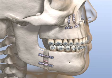 Bilateral Sagittal Split Osteotomy Bsso Surgery