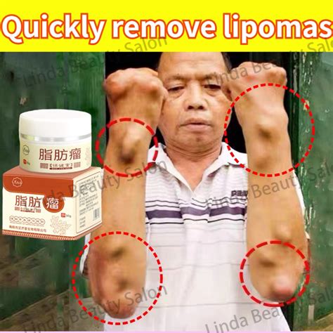 Original Lipoma Removal Cream Special Gel Removing Lipoma Subcutaneous