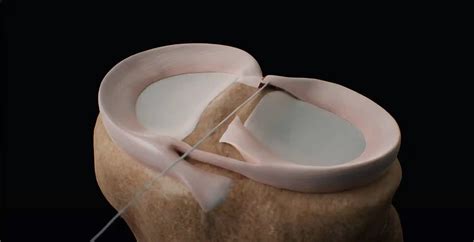 Sironix Medical Animation Visual Connections