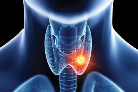 Dont Damage Your Thyroid Further By Making This Mistake Alpha Daily