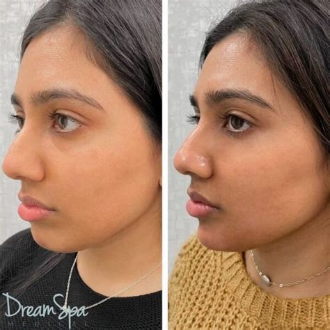 Cheek Filler Before And After Transforming Your Appearance With Subtle Enhancements Must Read