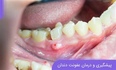 چگونه عفونت دندان را خارج کنیم؟ علائم و دلایل عفونت دندان