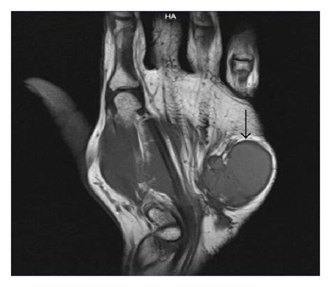 Synovial Sarcoma A 34 Year Old Female Patient Presented With