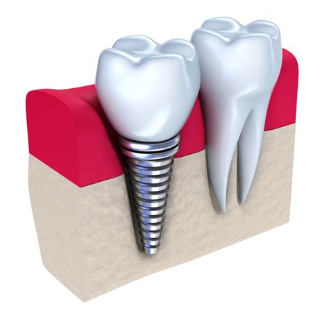 Astoria Dentist Answers What Is A Dental Implant Astoria Ny