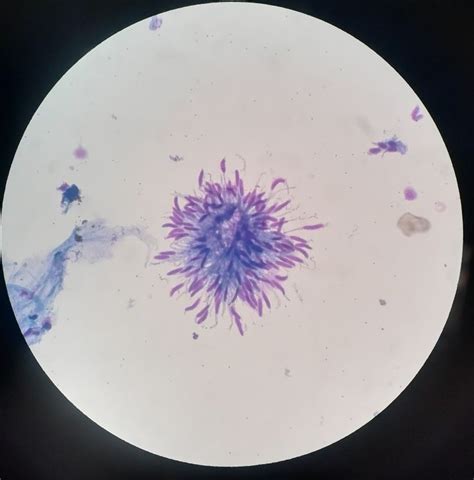 Stromal Cells In Cytology Specimen