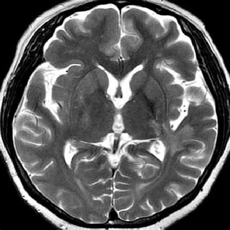 Pdf A Tumefactive Multiple Sclerosis Lesion In The Brain An Uncommon Site With Atypical