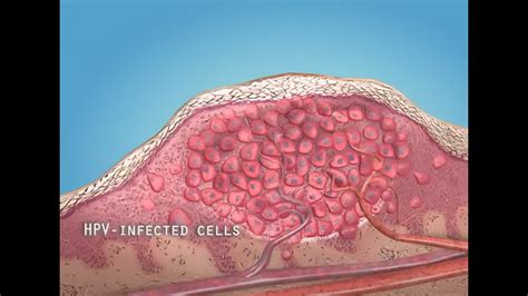 Wart Diagram Under Skin