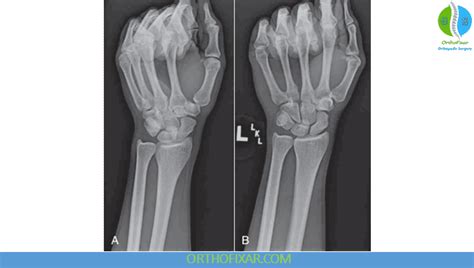 Wrist Radiology Imaging Standard Views Specialized Techniques And