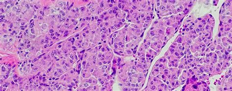 Evaluating The Prognostic Value Of Mitotic Rate Post Preoperative