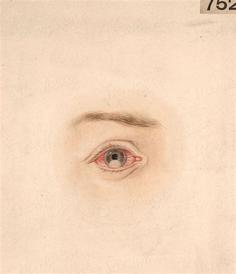 Eye Showing Dislocation Lens Anterior Free Photo Illustration Rawpixel